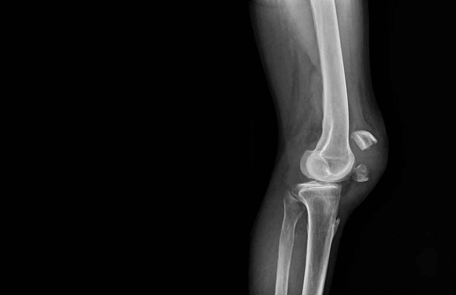 Fracture du genou ᐅ Causes et traitements ᐅ CAREA Kiné sport Paris